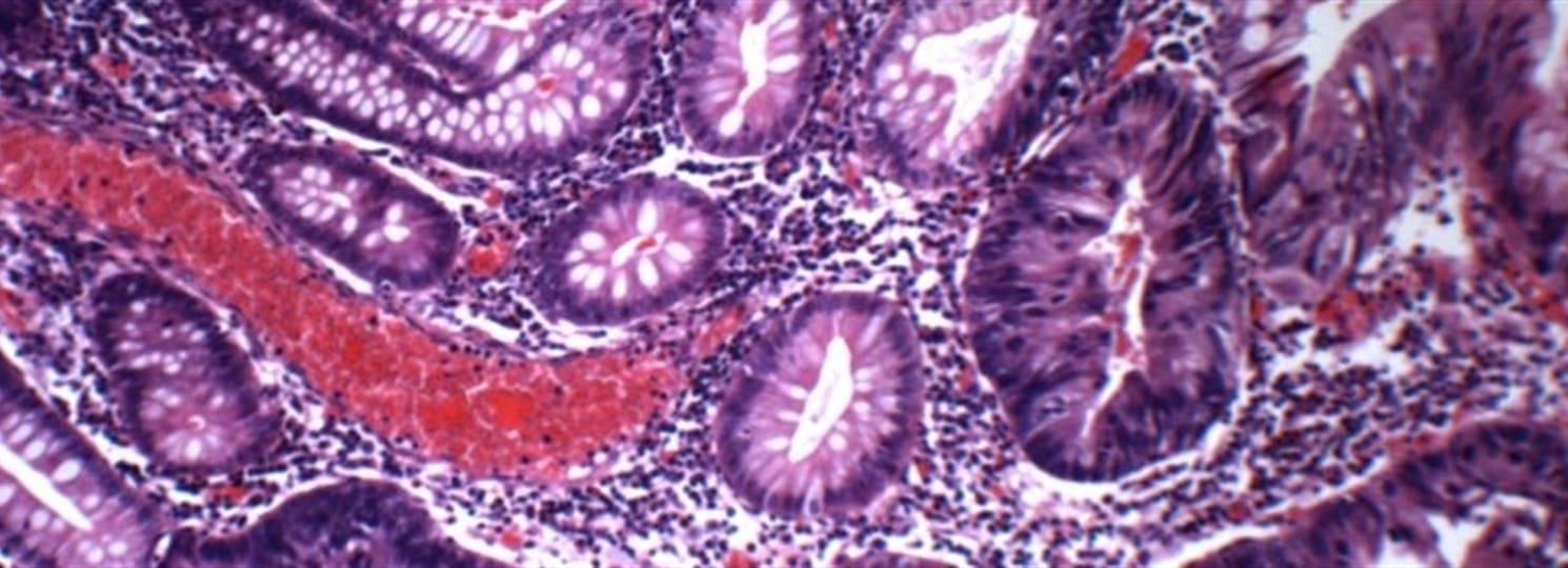 Targeting tissue stiffness to treat bowel cancer - Bowel Research UK ...